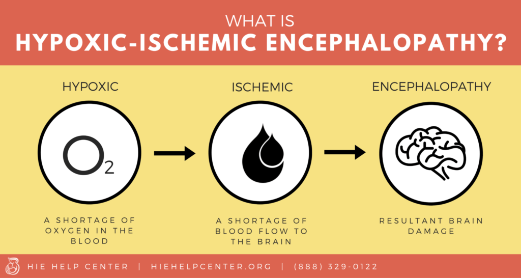Hypoxic Ischemic Encephalopathy Infographics And Images Hypoxic Ischemic Encephalopathy Infographics And Images