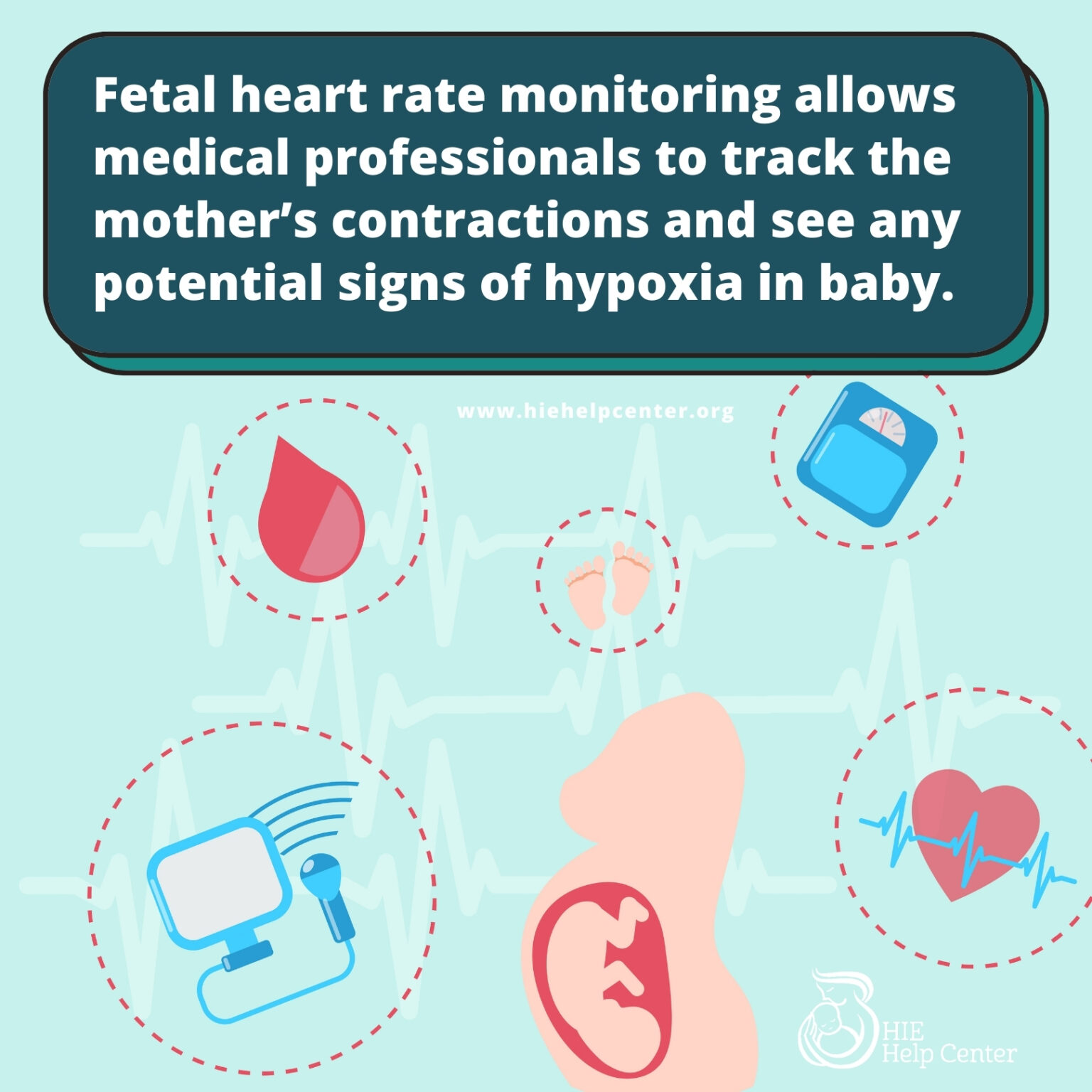 Signs of Fetal Distress During Pregnancy | The HIE Help Center