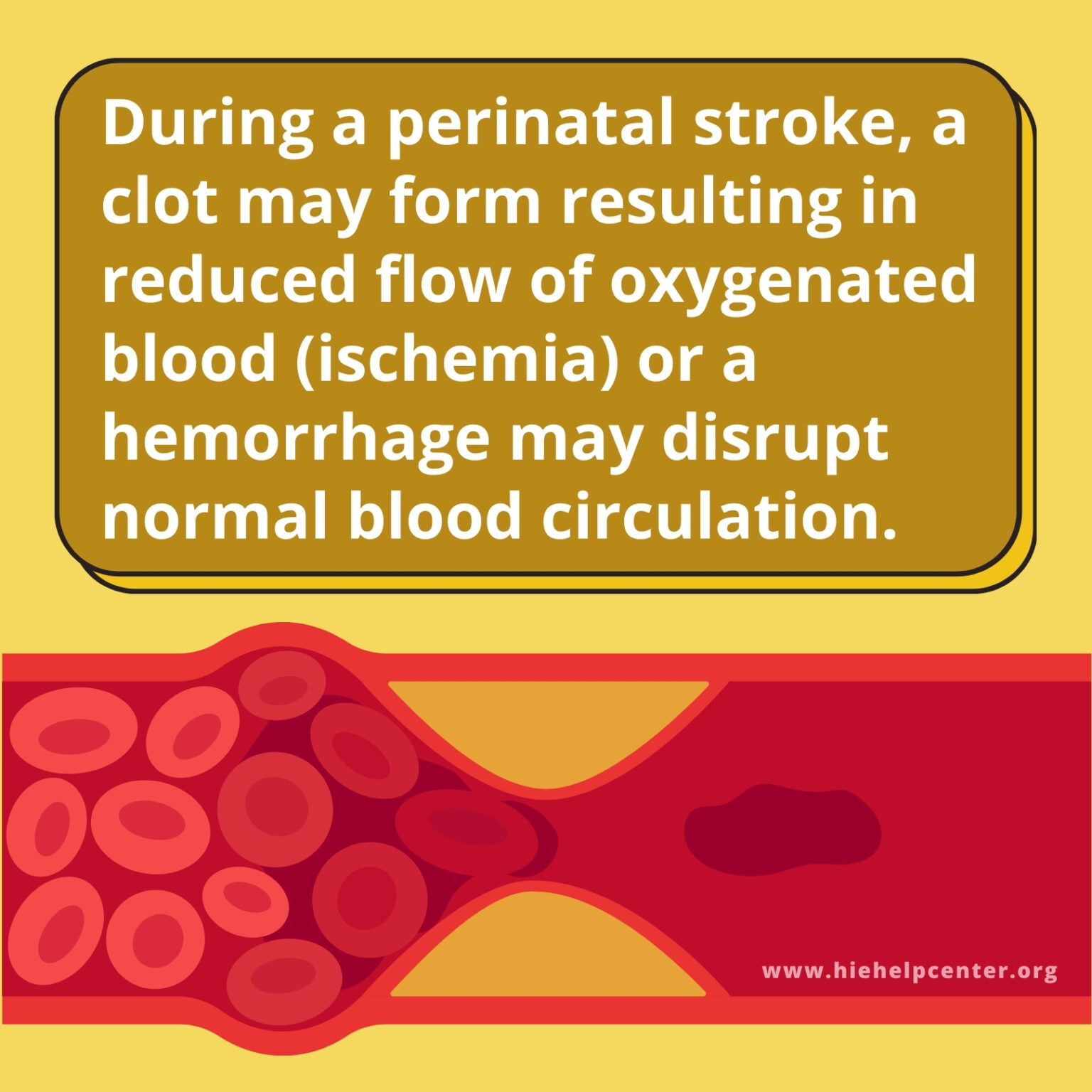 Perinatal Stroke | Causes of Hypoxic-Ischemic Encephalopathy
