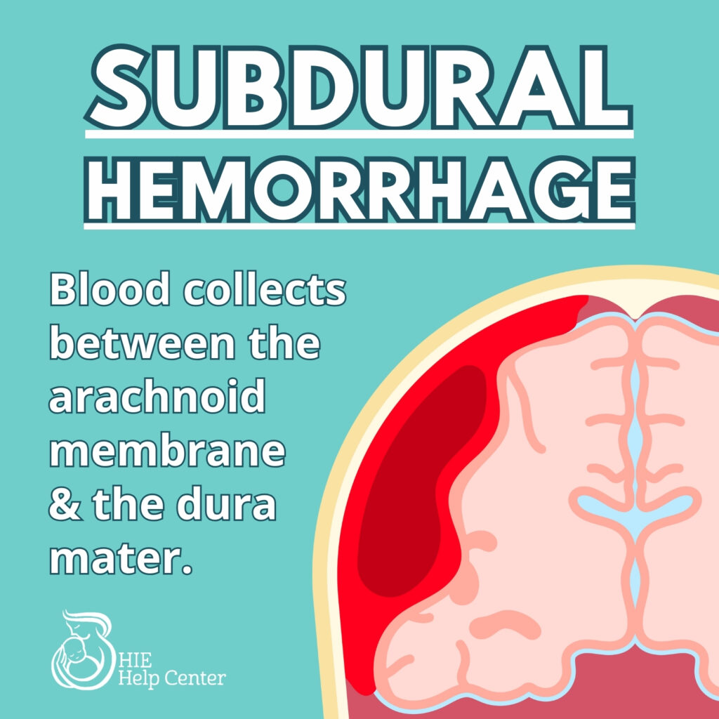 Intracranial Hemorrhages (Brain Bleeds) and Birth Injuries