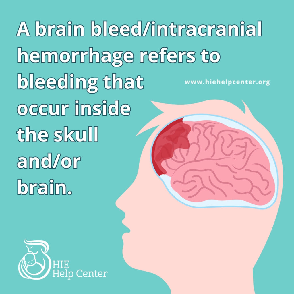 Intracranial Hemorrhages (Brain Bleeds) and Birth Injuries