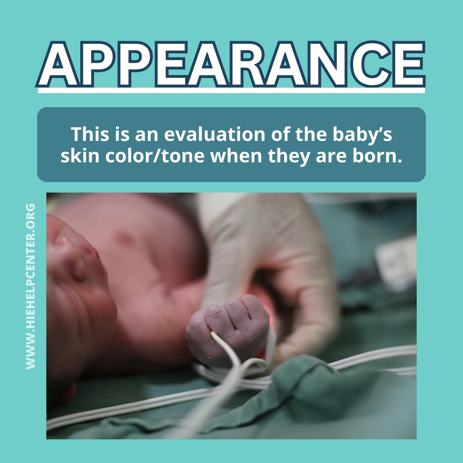 What is the Apgar Score? | The HIE Help Center